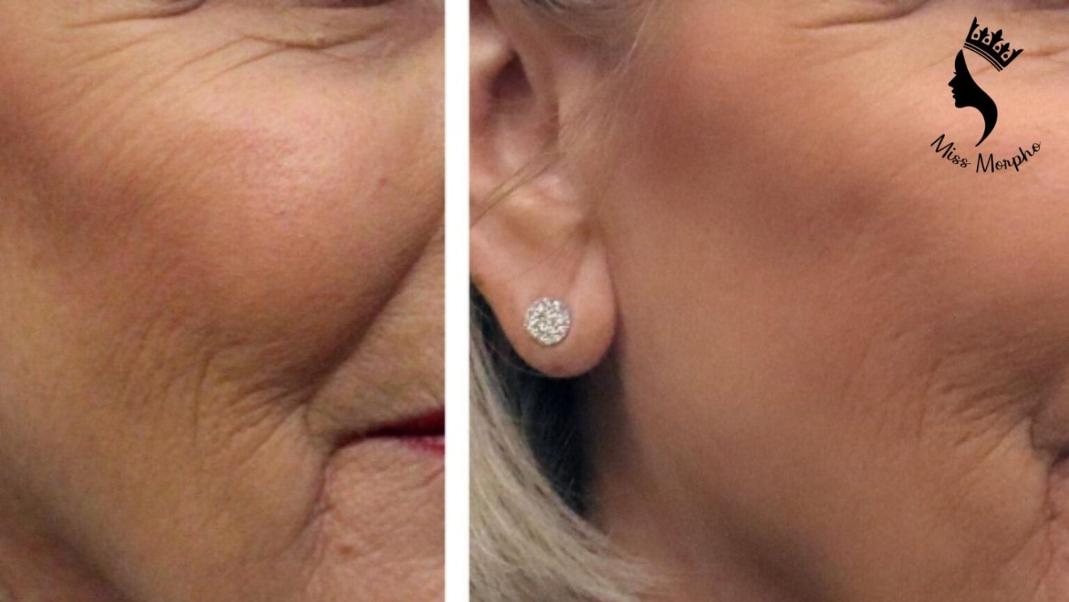 Micro Needling Before and fter - Miss Morpho
